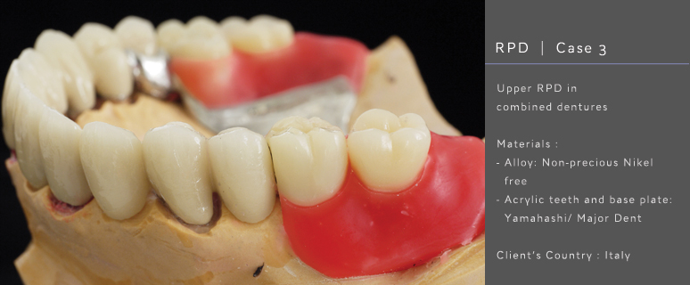 KDental-CO-CR PARTIAL DENTURE