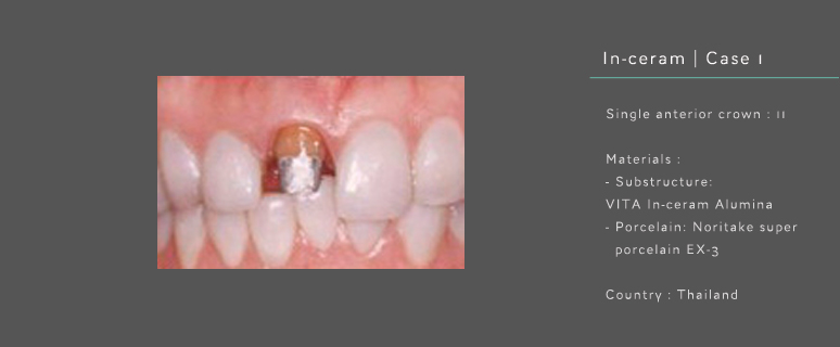 KDental-IN-CERAM